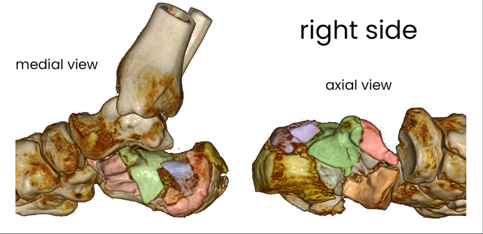 Calcaneal Fracture Both Sides Tongue Minimal Invasive Treatment Of