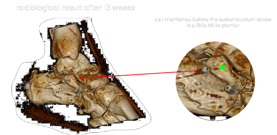 DT 19FT - Minimal invasive treatment of calcaneal fractures