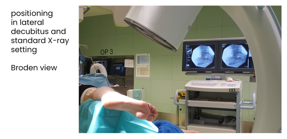 Calcaneal Fracture Both Sides Tongue Minimal Invasive Treatment Of