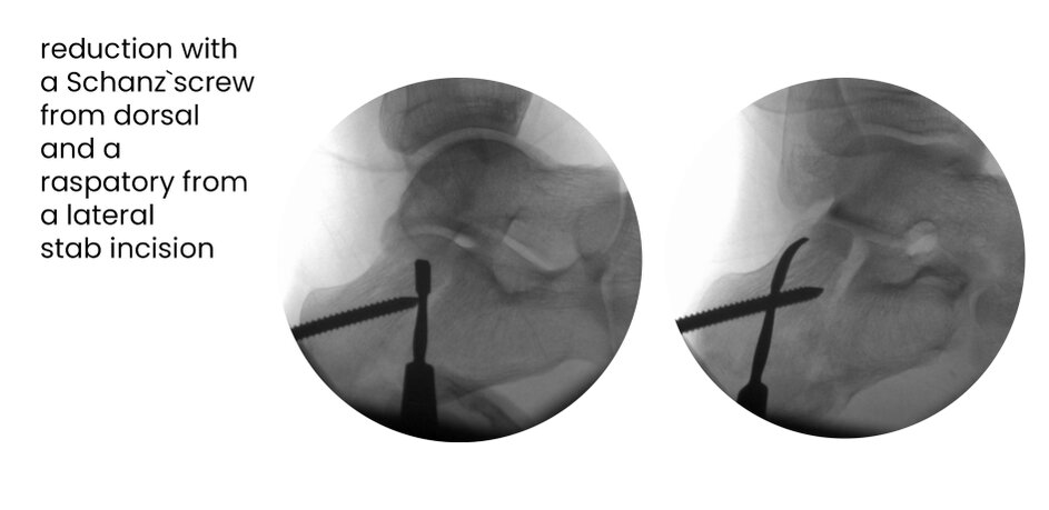 Calcaneal Fracture Both Sides Tongue Minimal Invasive Treatment Of
