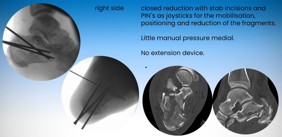 calcaneal fracture comminuted - Minimal invasive treatment of calcaneal ...