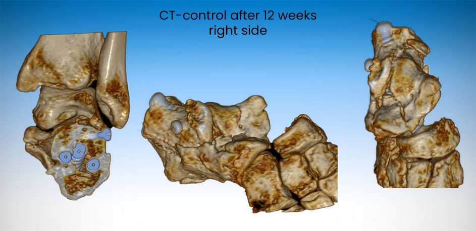 calcaneal fracture comminuted - Minimal invasive treatment of calcaneal ...