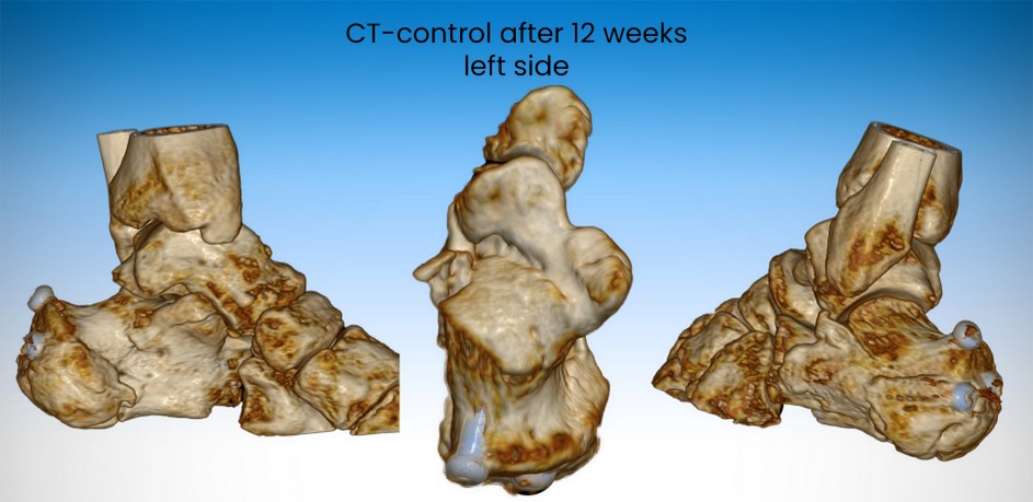calcaneal fracture comminuted - Minimal invasive treatment of calcaneal ...