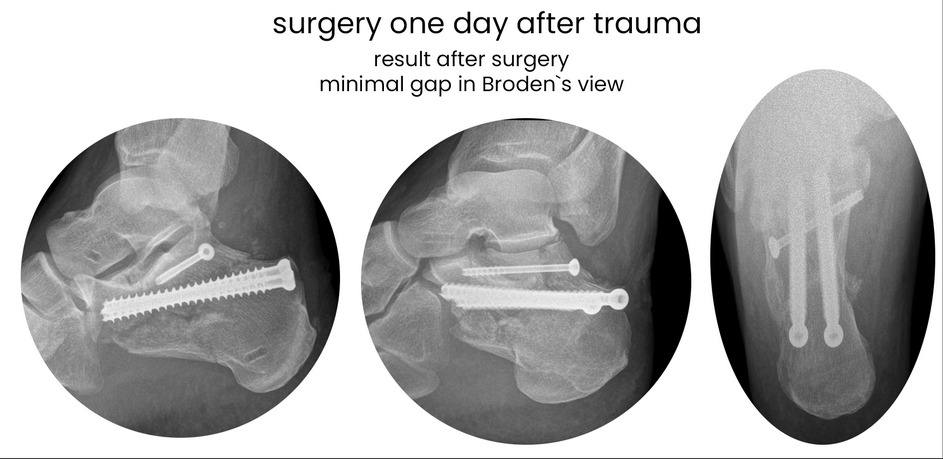 calcaneal fracture depression - Minimal invasive treatment of calcaneal ...