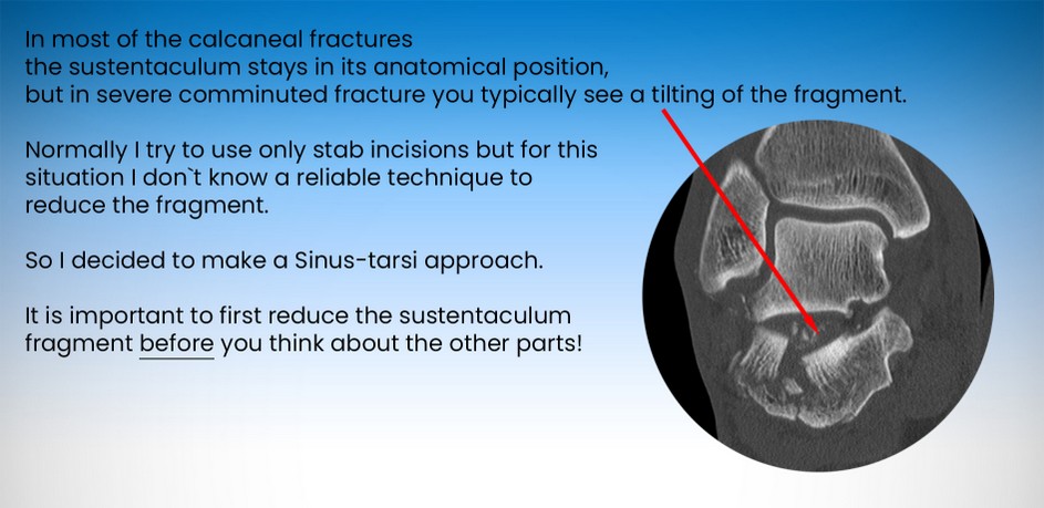 calcaneal fracture comminuted - Minimal invasive treatment of calcaneal ...